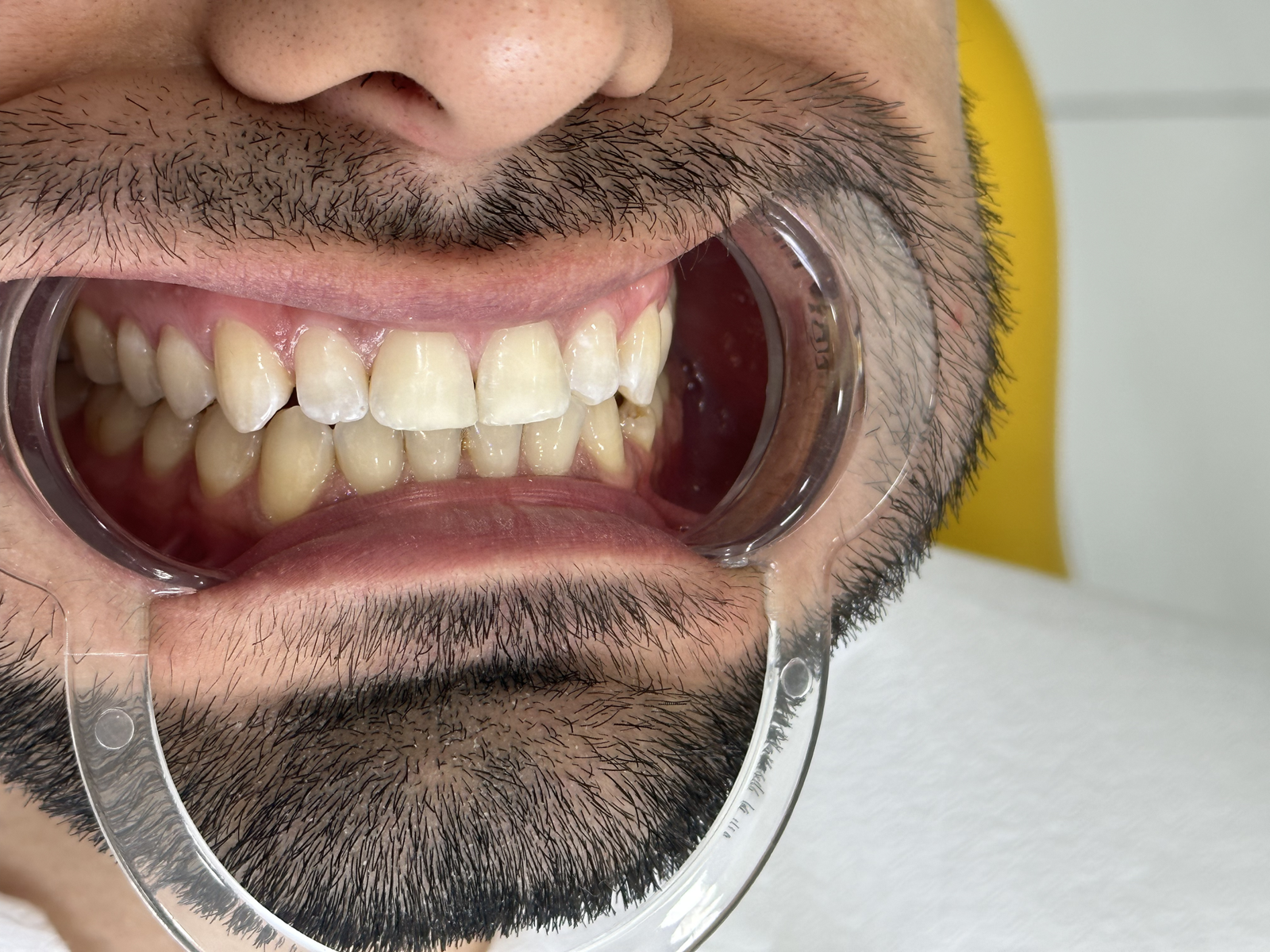 Aesthetic Filling - Aydın Clinic